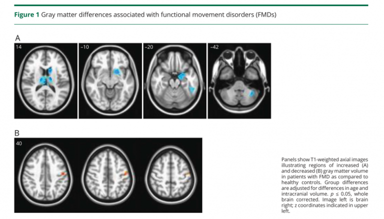 Can people with FND have changes to the structure of their brain too ...