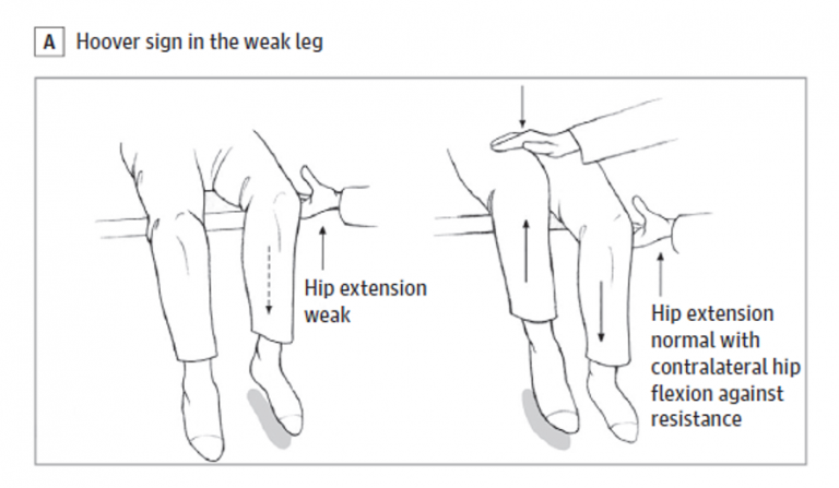 How reliable are the clinical Signs of FND? – Functional Neurological ...