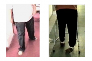 Functional Limb Weakness – Functional Neurological Disorder (FND)