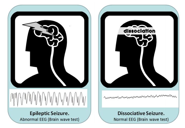 Functional Dissociative Seizures Functional Neurological Disorder FND 