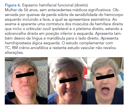 Espasmo Facial Funcional – Functional Neurological Disorder (FND)